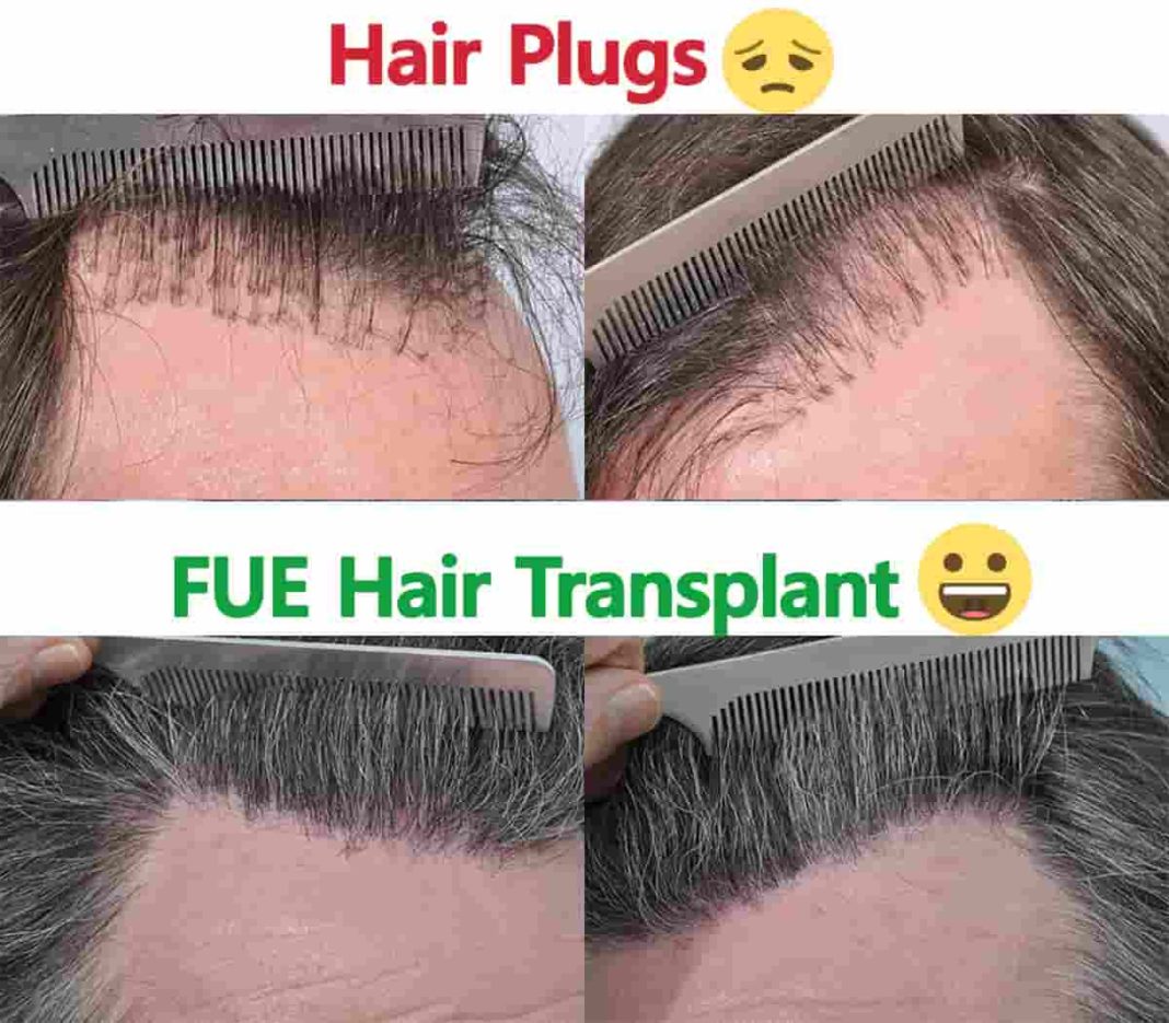 Hair Plugs For Men - Troy Hair