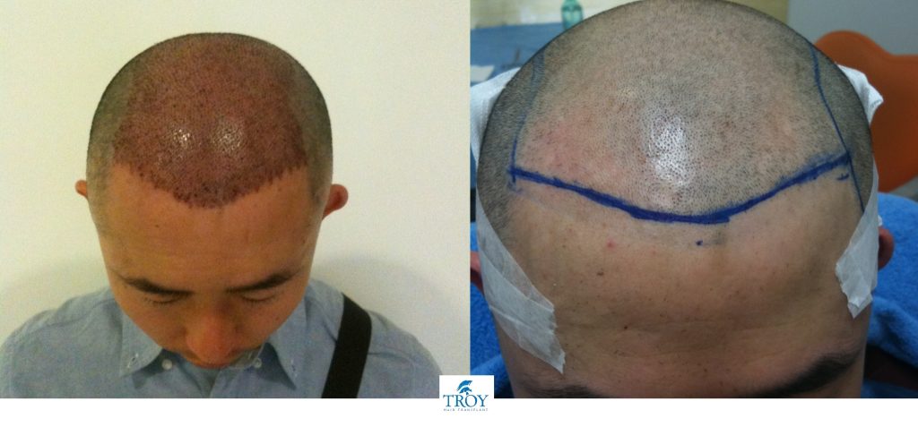 Hair Restoration - Troy Hair